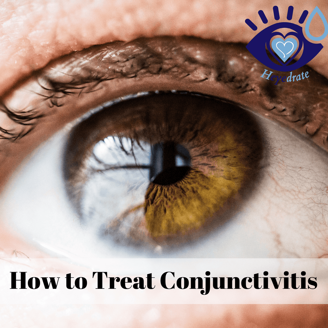 How to Treat Conjunctivitis – Eye Love