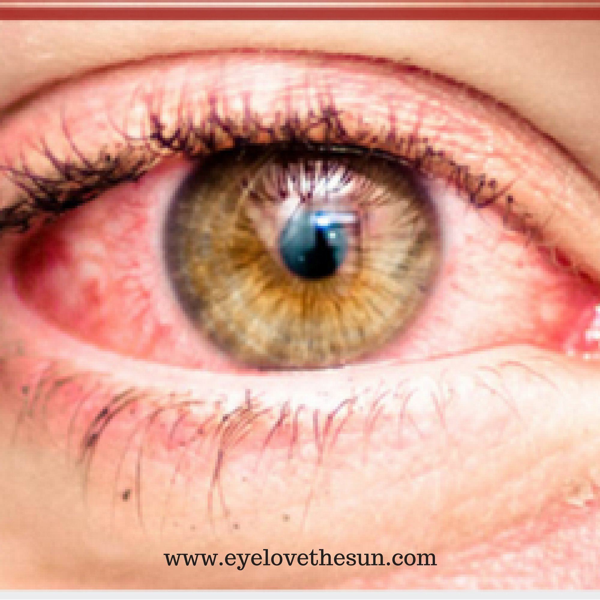 What is Pink Eye – Eye Love